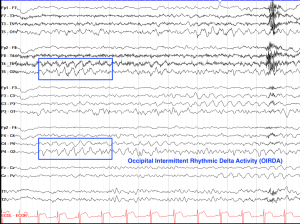 Delta - Neuro Pathway