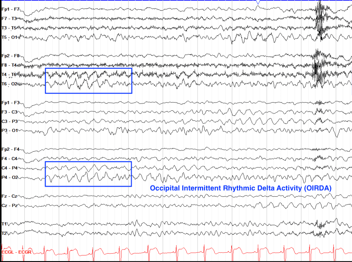 Delta - Neuro Pathway