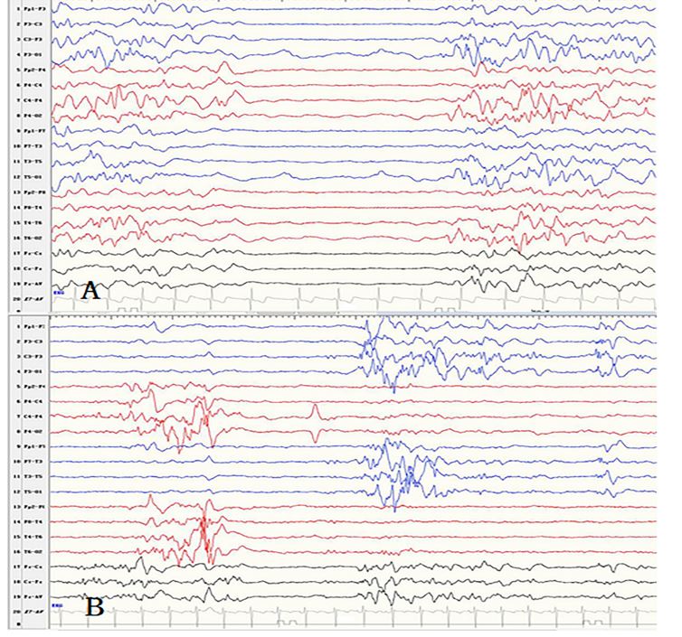 Early Infantile Developmental and Epileptic Encephalopathy syndrome ...