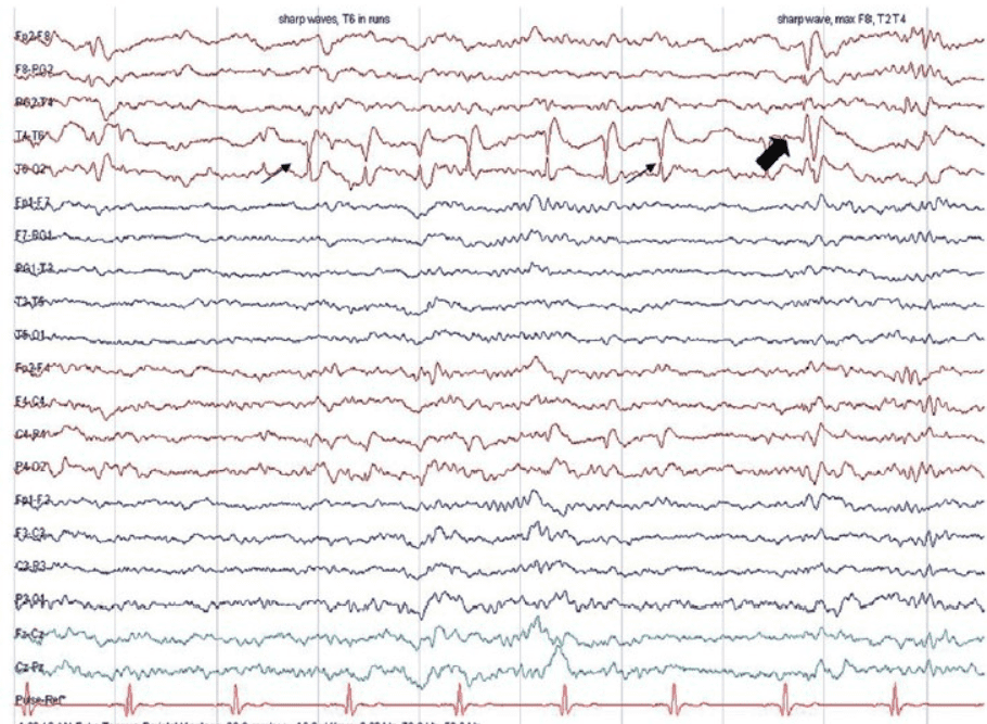 Seizures and Epilepsy: Lateral Temporal Lobe - Neuro Pathway