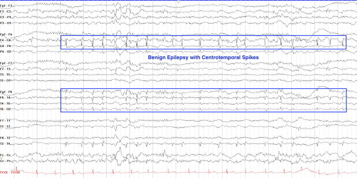 Rolandic Spikes - Neuro Pathway