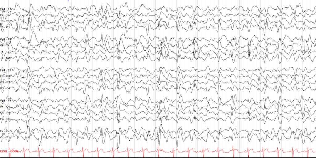 Slow Spike and Wave (SSW) Complexes - Neuro Pathway