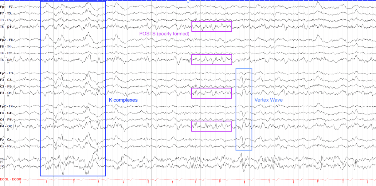 Vertex Sharp Wave Transients - Neuro Pathway